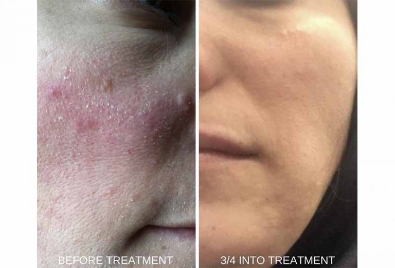 Demodex Treatment Testimonial | Ungex Products