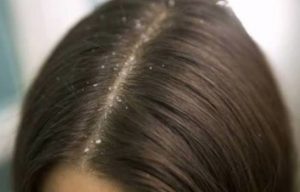 Dandruff and Demodex Mites | Ungex | Demodex Treatment