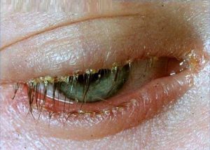 Blepharitis and Demodex mites - Ungex | Demodex treatment