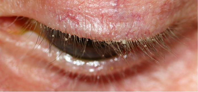 Demodex Blepharitis