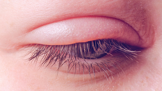 eyelash - Ungex | Demodex treatment