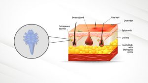 Demodex Mites: Die-off Symptoms - Ungex | Demodex treatment