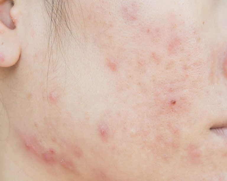 Acne and Demodex Mites | Ungex | Demodex Treatment