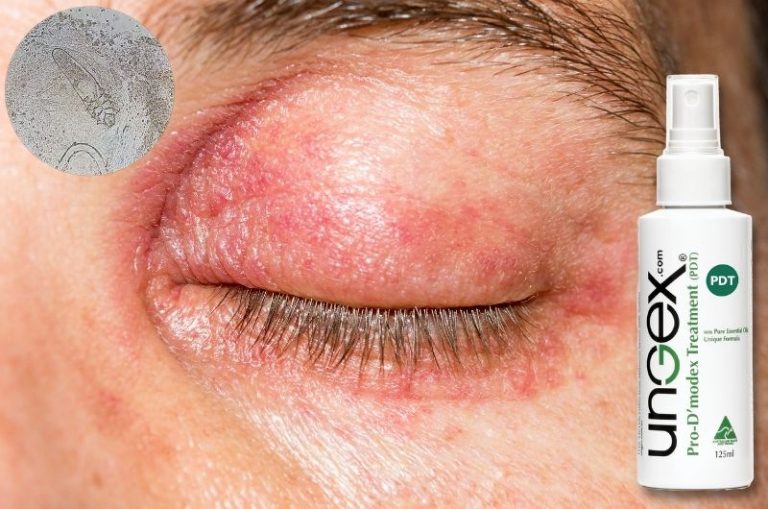 Red Skin around Eyes: Is It Related to Demodex Mites? | Ungex