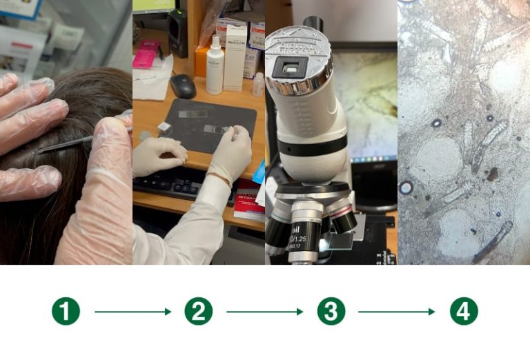 Demodex Test: How to Diagnose Demodex Mite Infection | Ungex