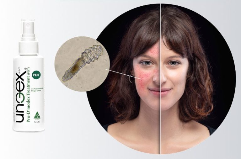 Demodex Mites: Die-off Symptoms - Ungex | Demodex treatment