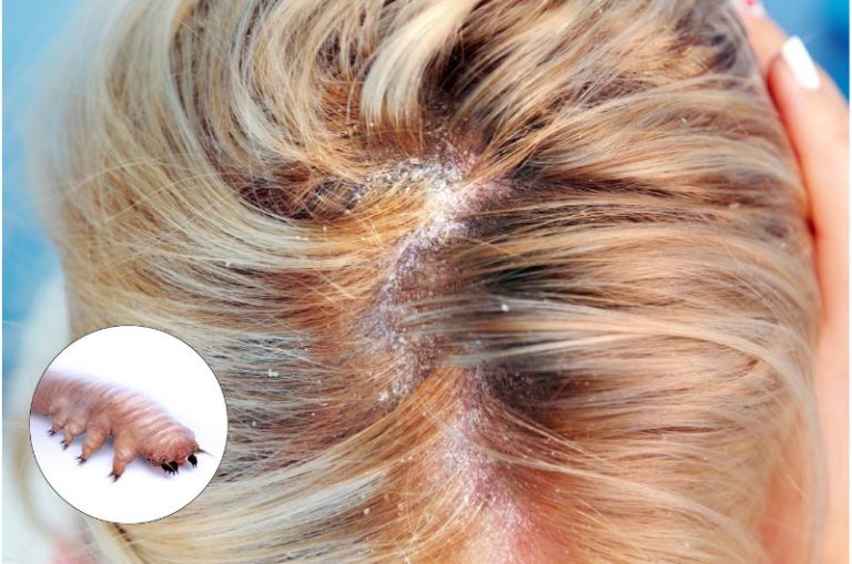 Demodex Mites: Die-off Symptoms - Ungex | Demodex treatment