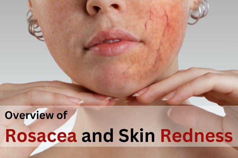 Overview of Rosacea and Skin Redness - Ungex | Demodex treatment