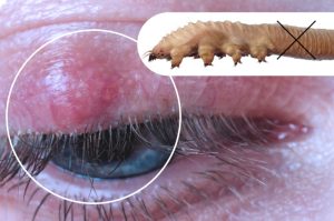 Eyelash Extensions, Demodex and Blepharitis | Ungex