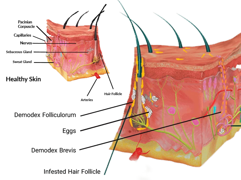 Does Vinegar Kill Demodex Mites How To Get Rid Of Rosacea Permanently?